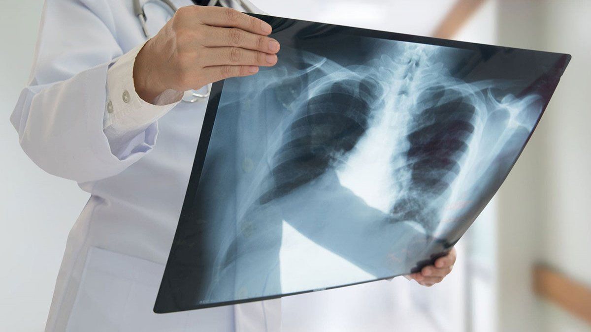 COVID: uno de cada 100 pacientes sufre perforación de pulmón